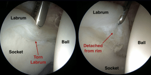 Labrum Hip Injury Treatment | North Hollywood | Orthopedic Surgeon ...