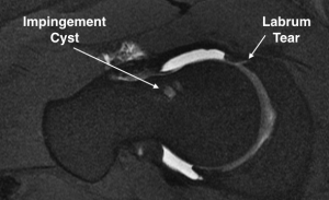Labrum Hip Injury Treatment | North Hollywood | Orthopedic Surgeon ...