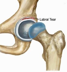 Labral Tear Caused By Repetitive Motions | Los Angeles, Beverly Hills ...